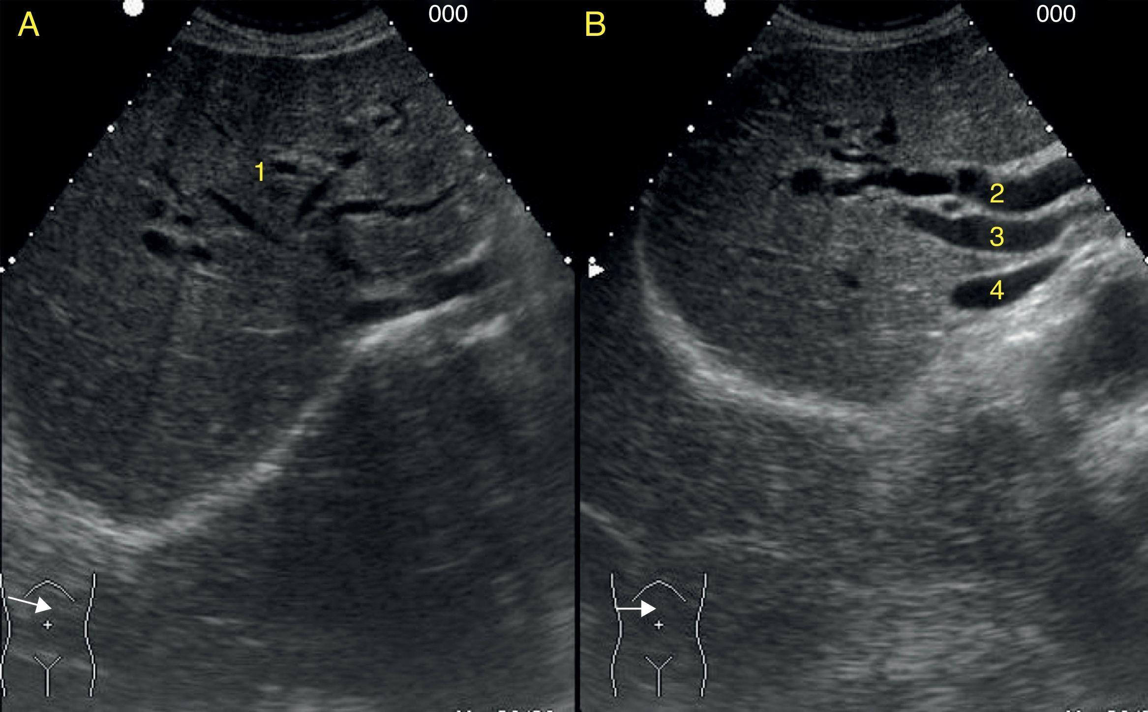 Ecografía de la vesícula y la vía biliar | Medicina de Familia. SEMERGEN