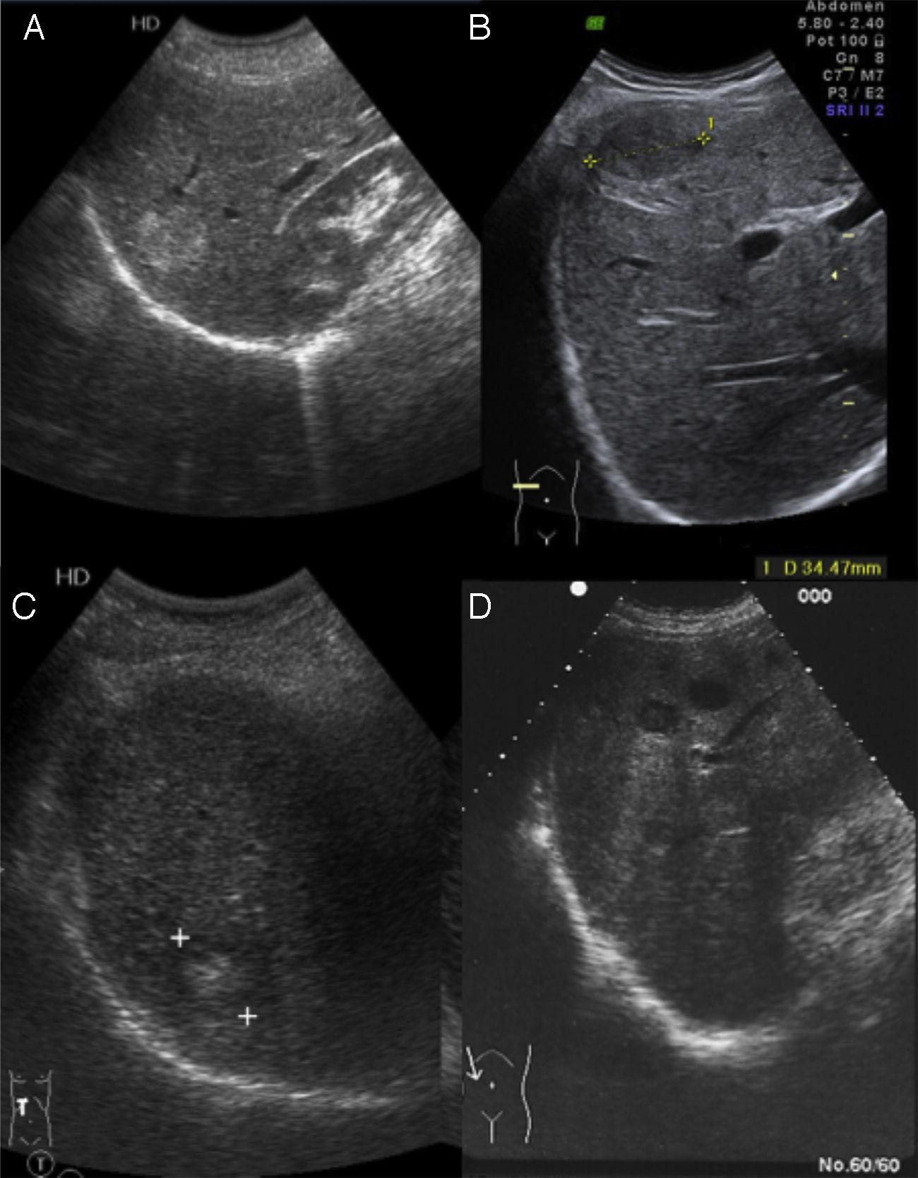 Ecografía hepática: lesiones focales y enfermedades difusas | Medicina ...