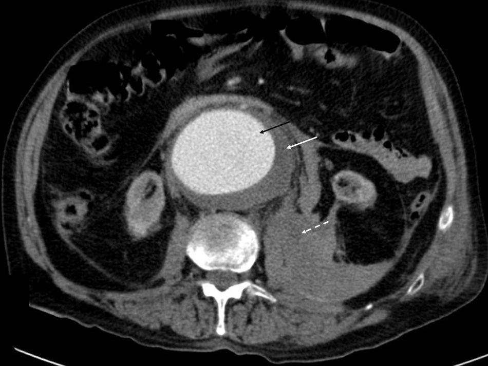 Dolor testicular como forma de presentación de un síndrome aórtico ...