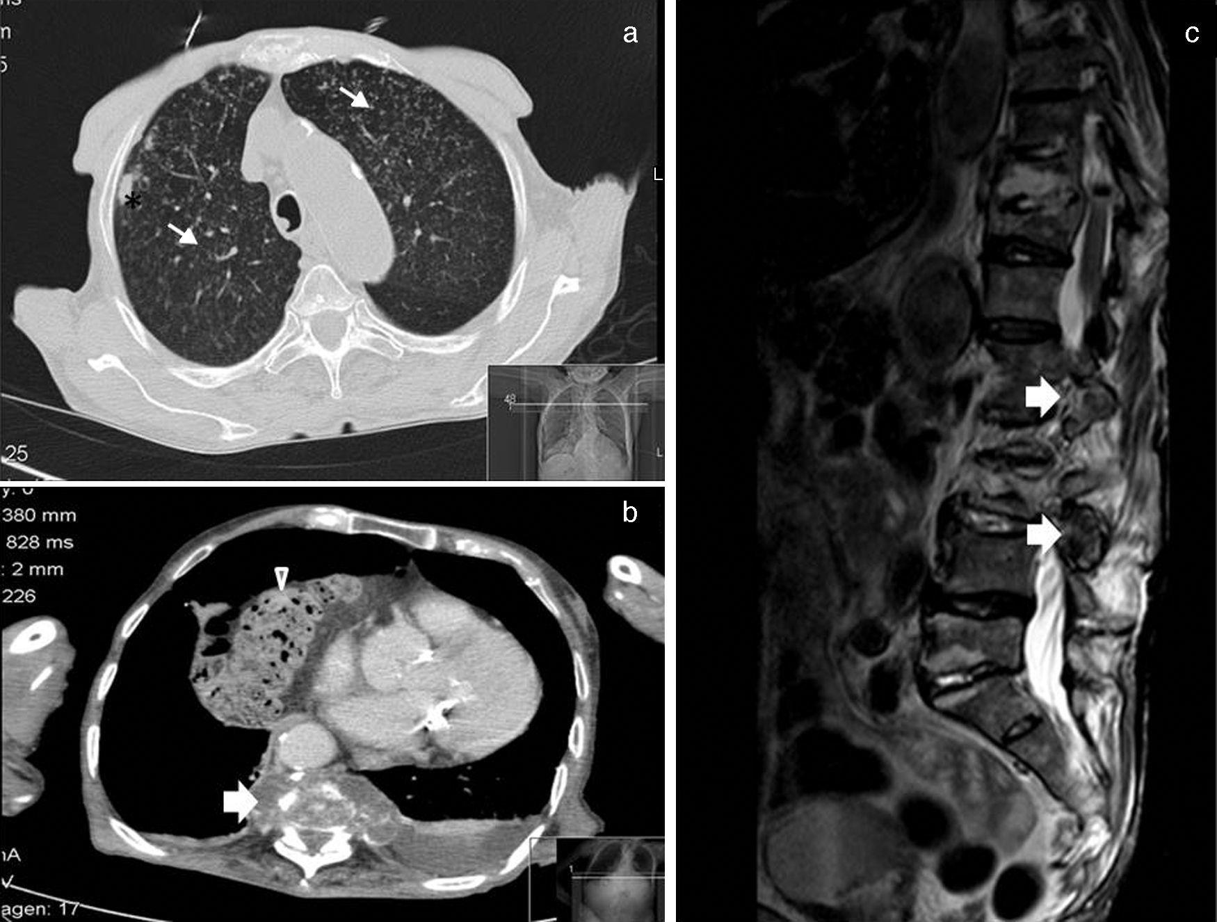 Tuberculosis diseminada en anciano de edad avanzada | Medicina de ...
