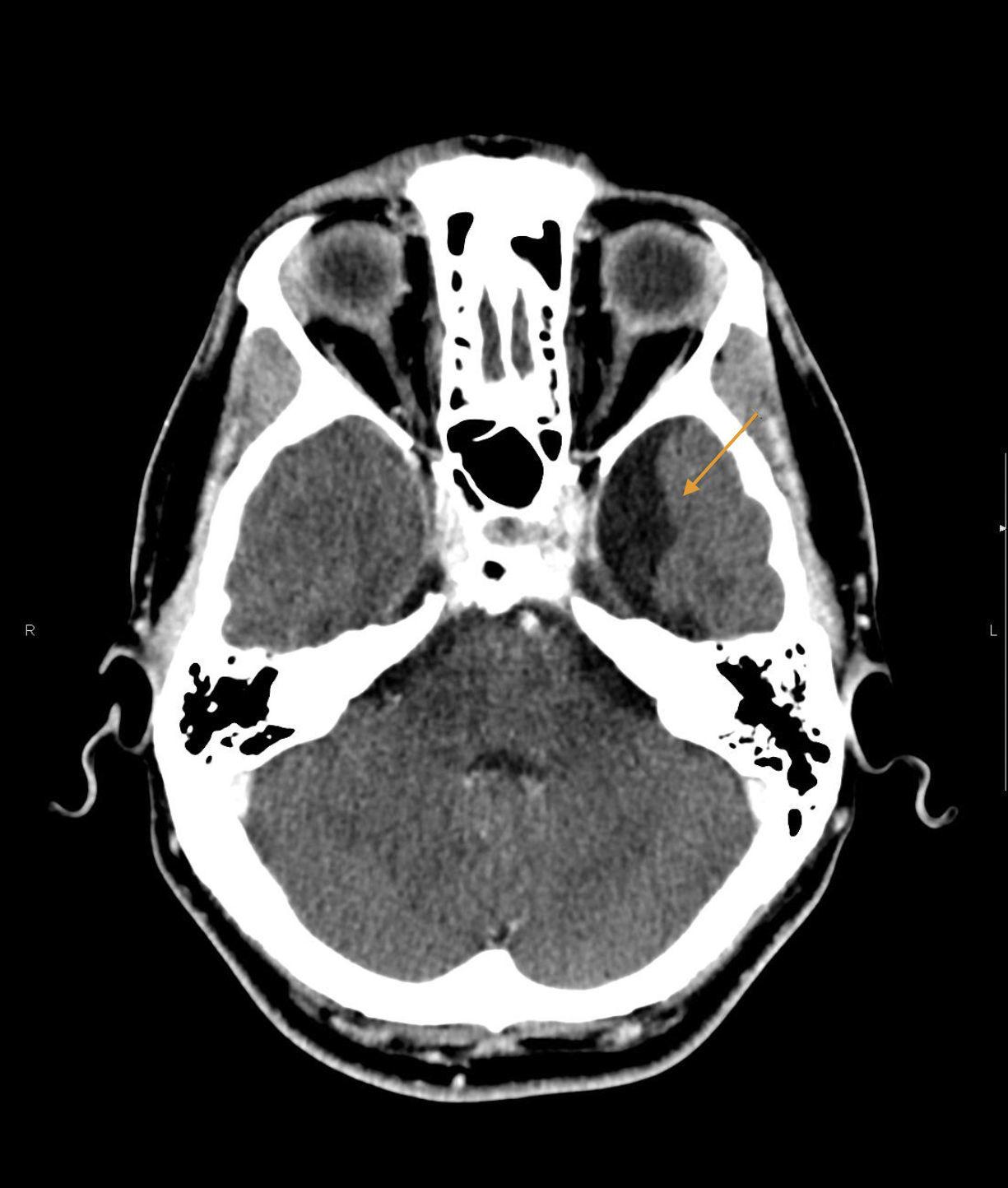 Quiste aracnoideo en polo temporal izquierdo.