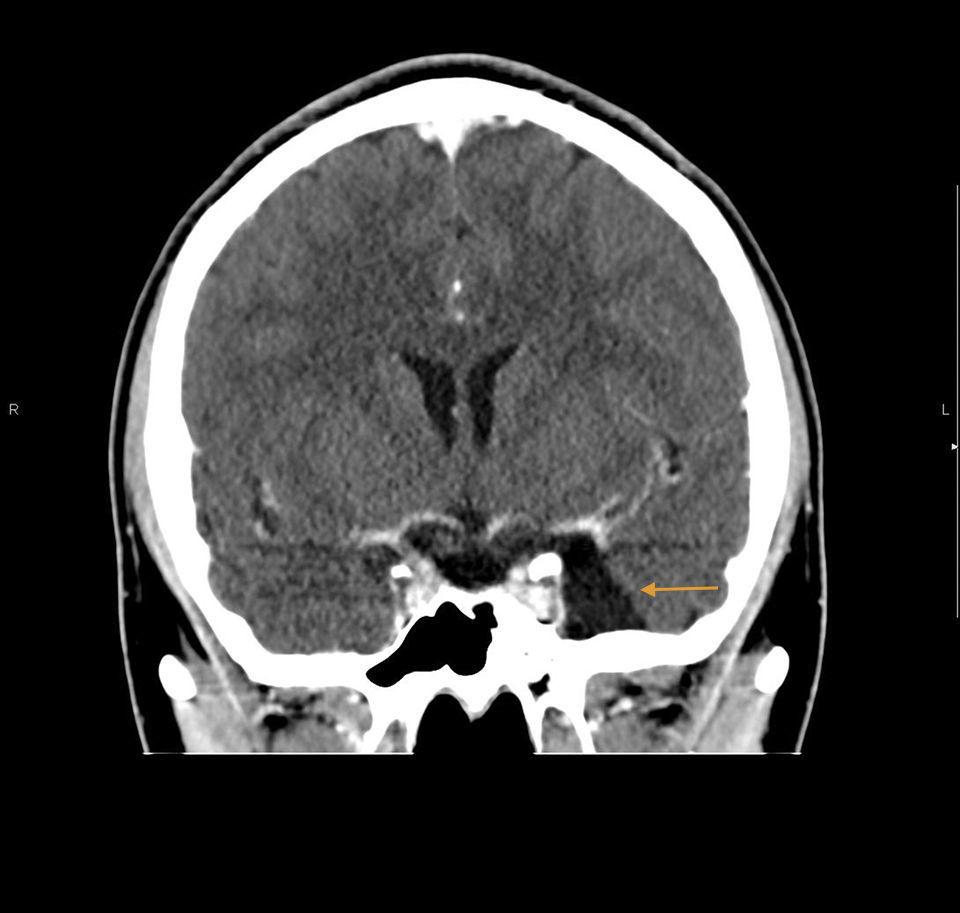 Somnolencia cataplejía o sd. de Gelineau en urgencias de Atención ...