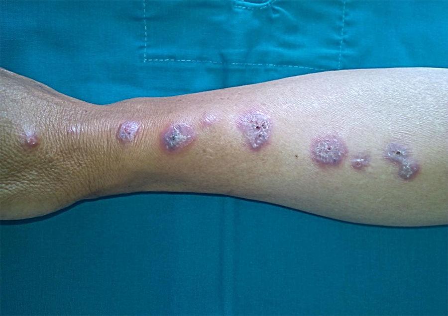 Nódulos eritematosos con distribución lineal | Medicina de Familia ...