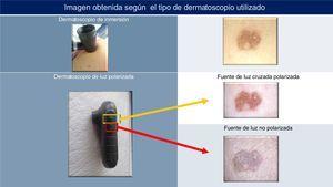 Dermatoscopia para principiantes (i): características generales ...