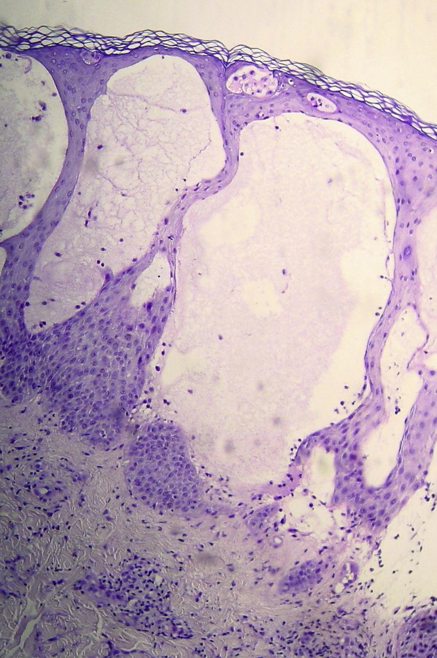 Fitofotodermatitis diseminada, una entidad nosológica a conocer ...