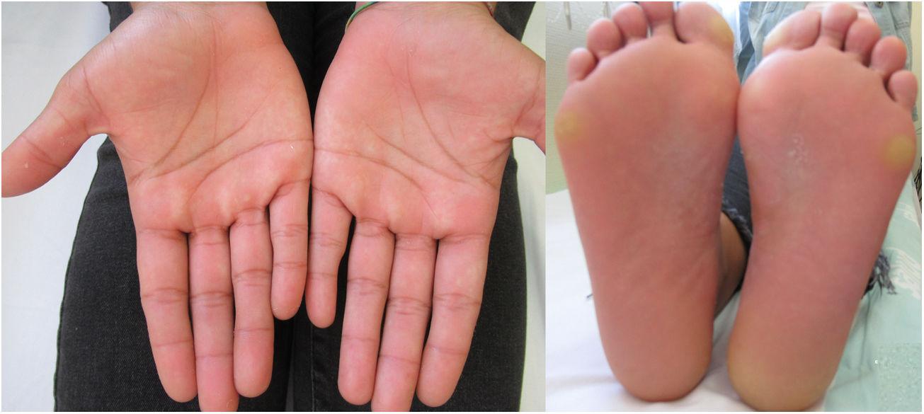 Hiperqueratosis palmoplantar de larga evolución | Medicina de Familia ...