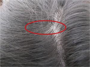 Cefalea numular. A propósito de un caso | Medicina de Familia. SEMERGEN