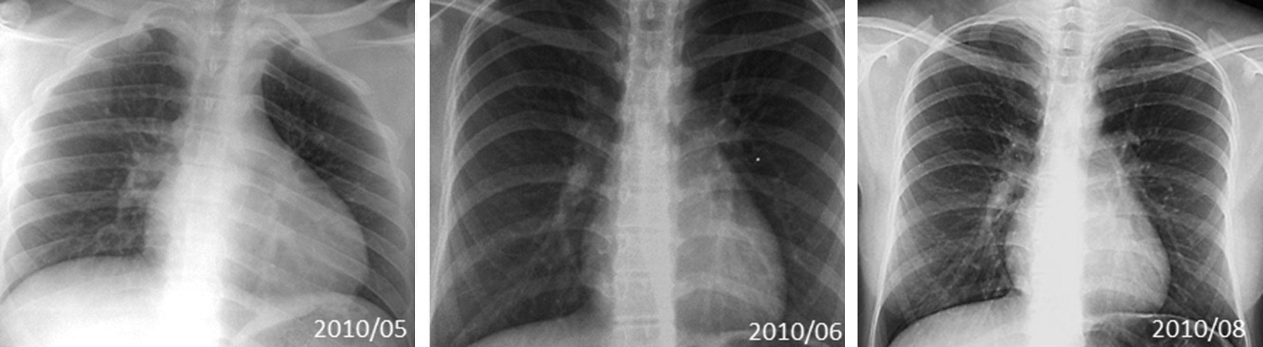 Cardiomyopathy induced by incessant fascicular ventricular tachycardia ...