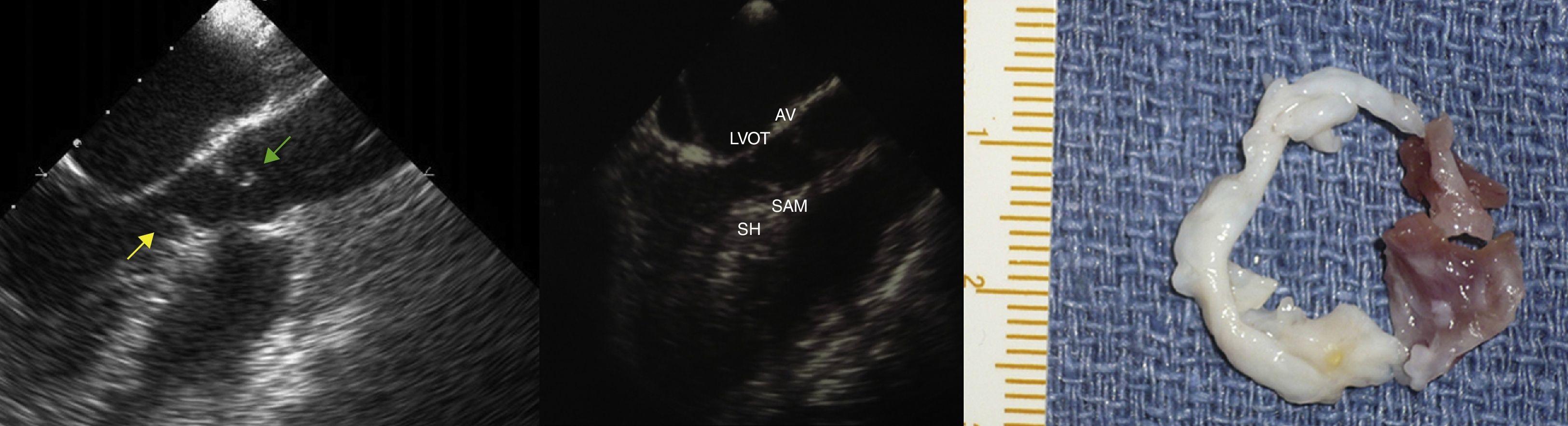Aortic stenosis in the background of a subaortic membrane and tunnel ...