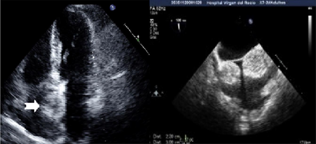 Hipertrofia lipomatosa masiva del septo interauricular: diagnóstico por ...