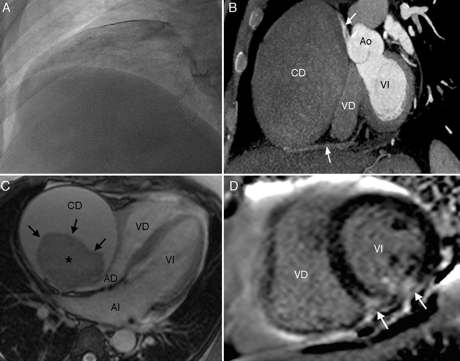Infarto inferior con extensión a ventrículo derecho secundario a ...