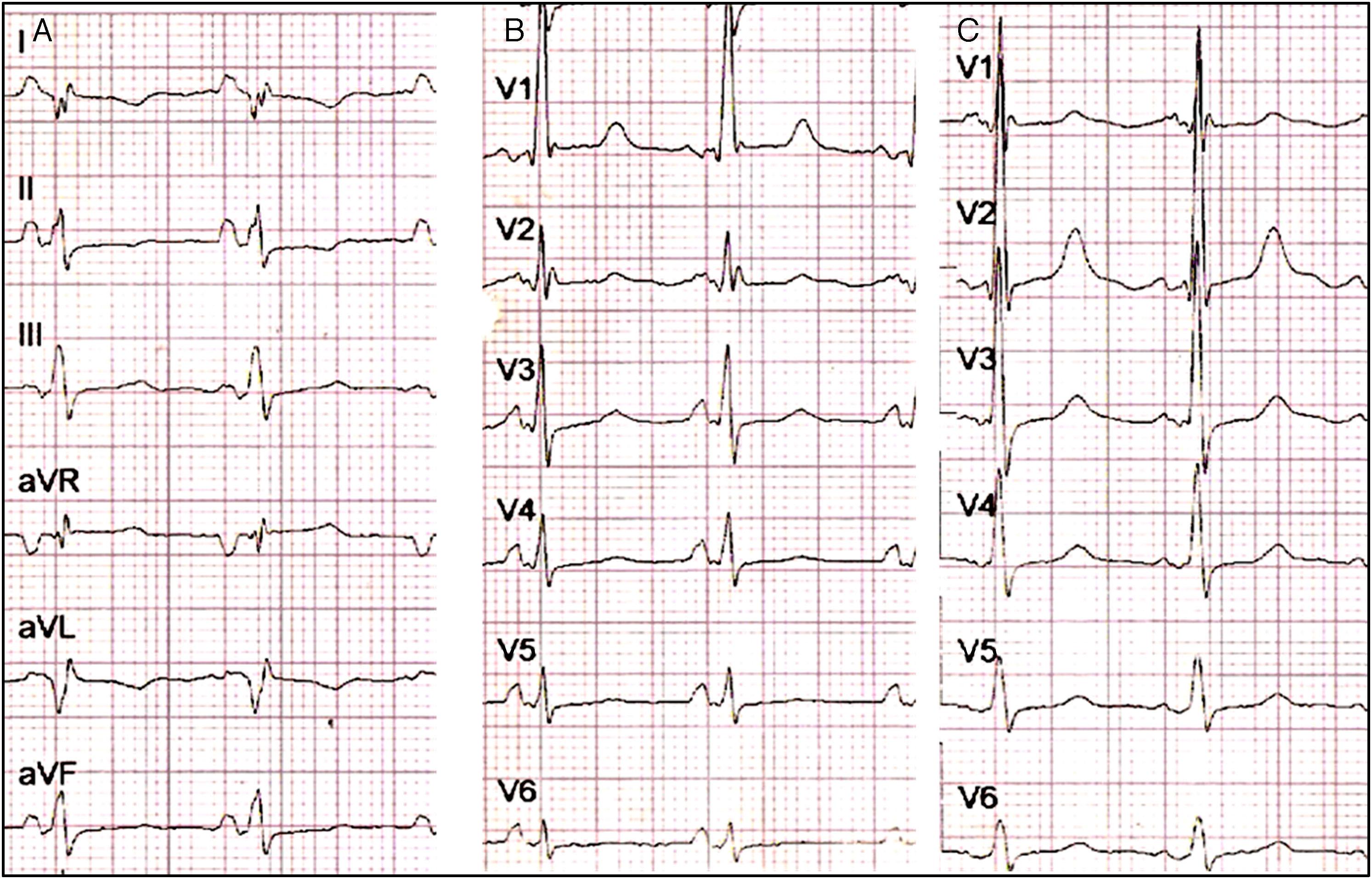 Dextrocardia, coartación aórtica y enfermedad arterial coronaria ...