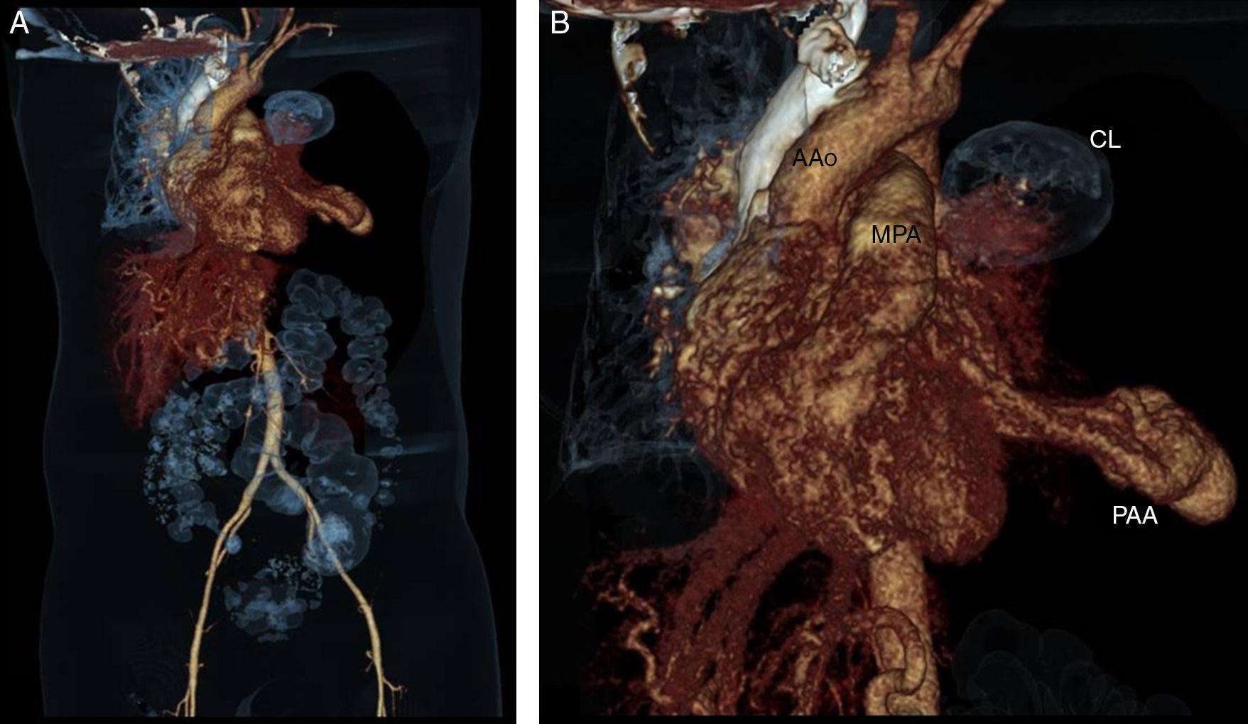 Ruptured pulmonary artery aneurysm, a surgical emergency. A case report ...