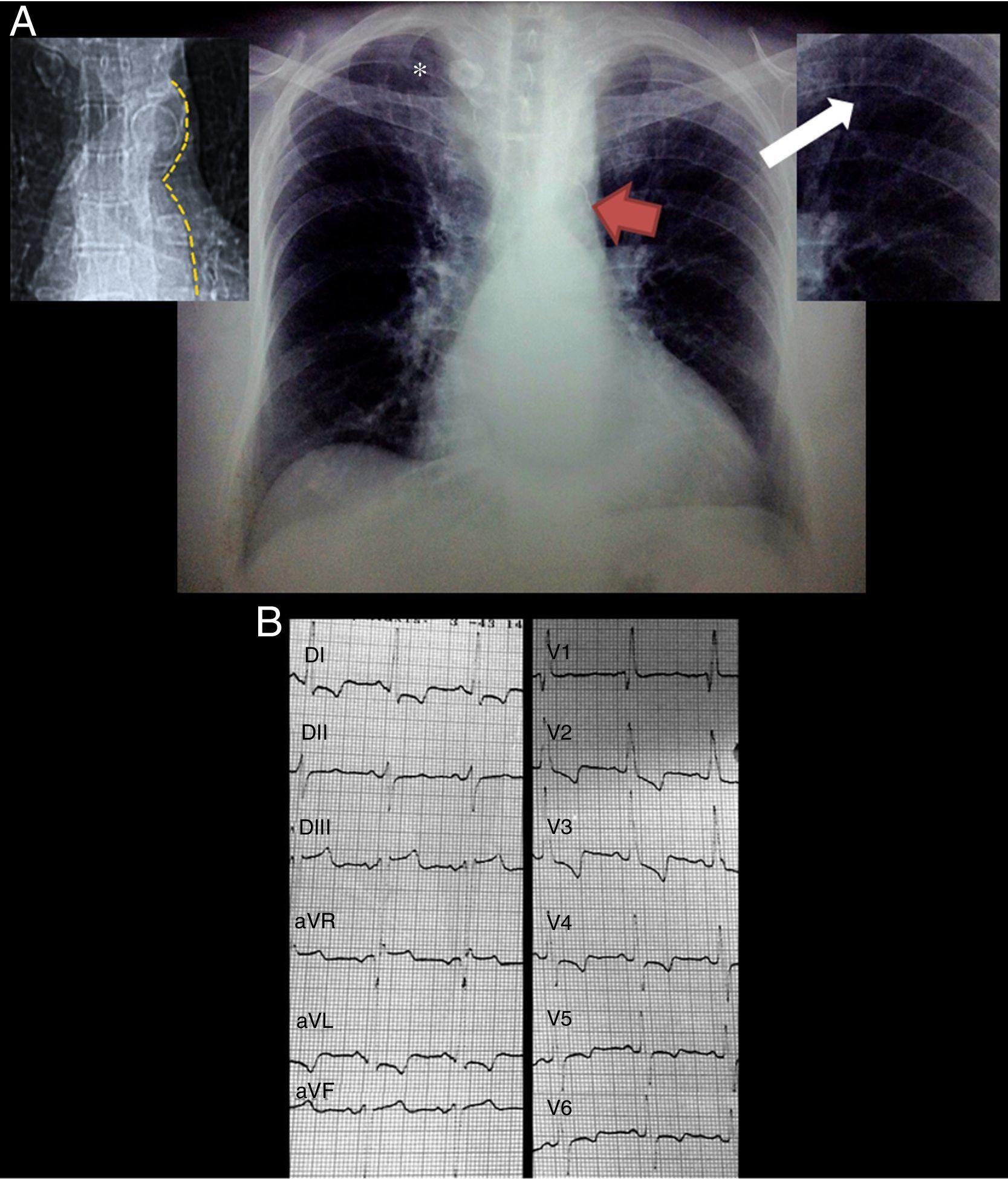 Complex aortic coarctation and a bicuspid aortic valve with severe ...