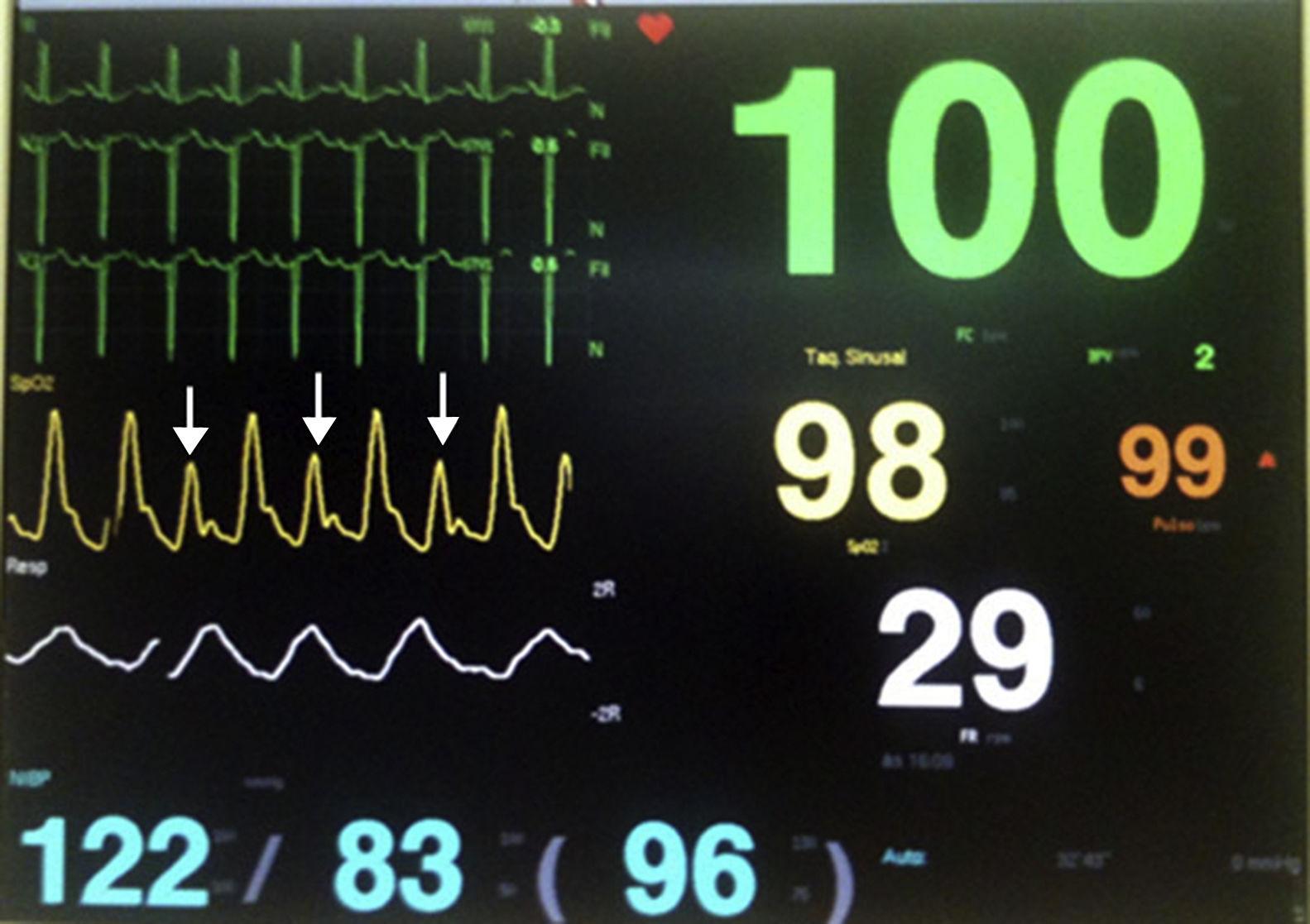 Pulsus alternans: An ominous sign | Archivos de Cardiología de México