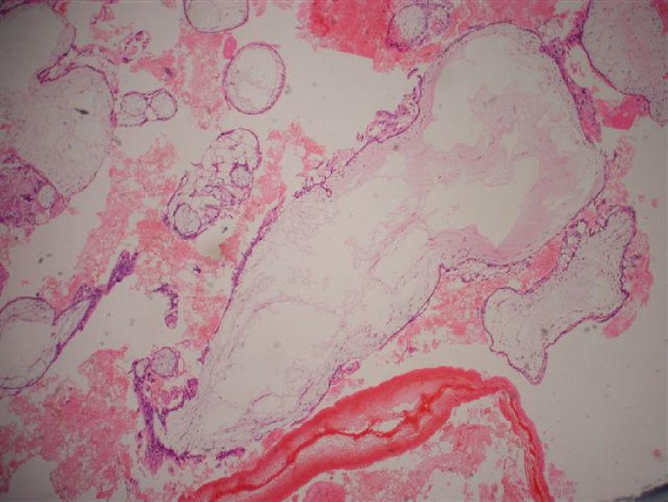 Gestação gemelar com mola hidatiforme completa e feto vivo após ...