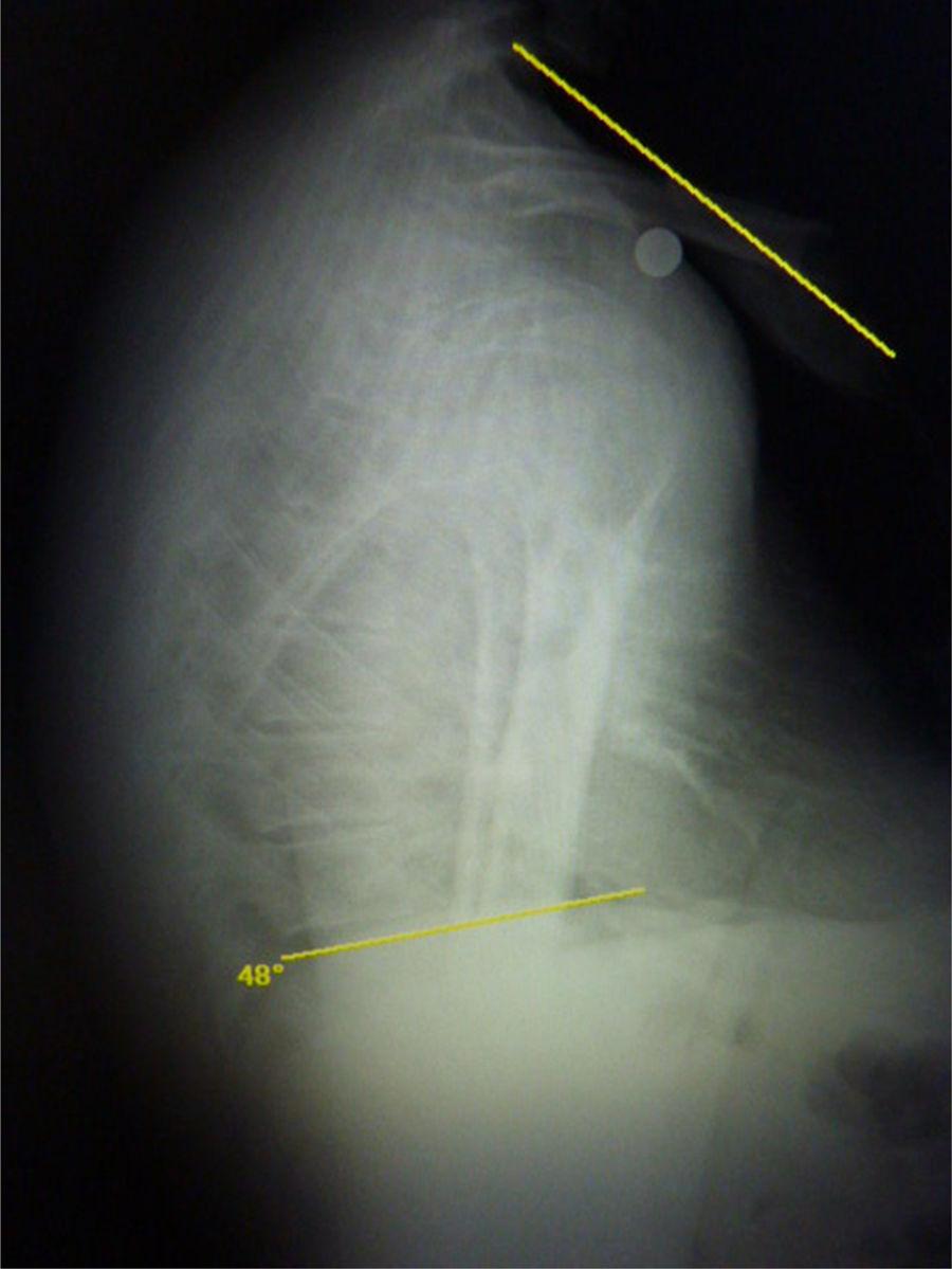 Is the inclinometer a valid measure of thoracic kyphosis? A cross ...