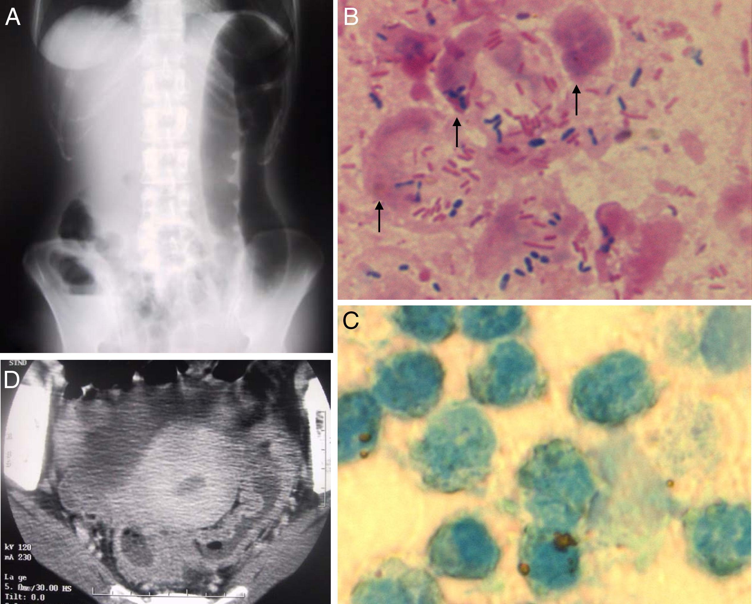 Fecal leukocyte in the diagnosis of ulcerative colitis | The Brazilian ...