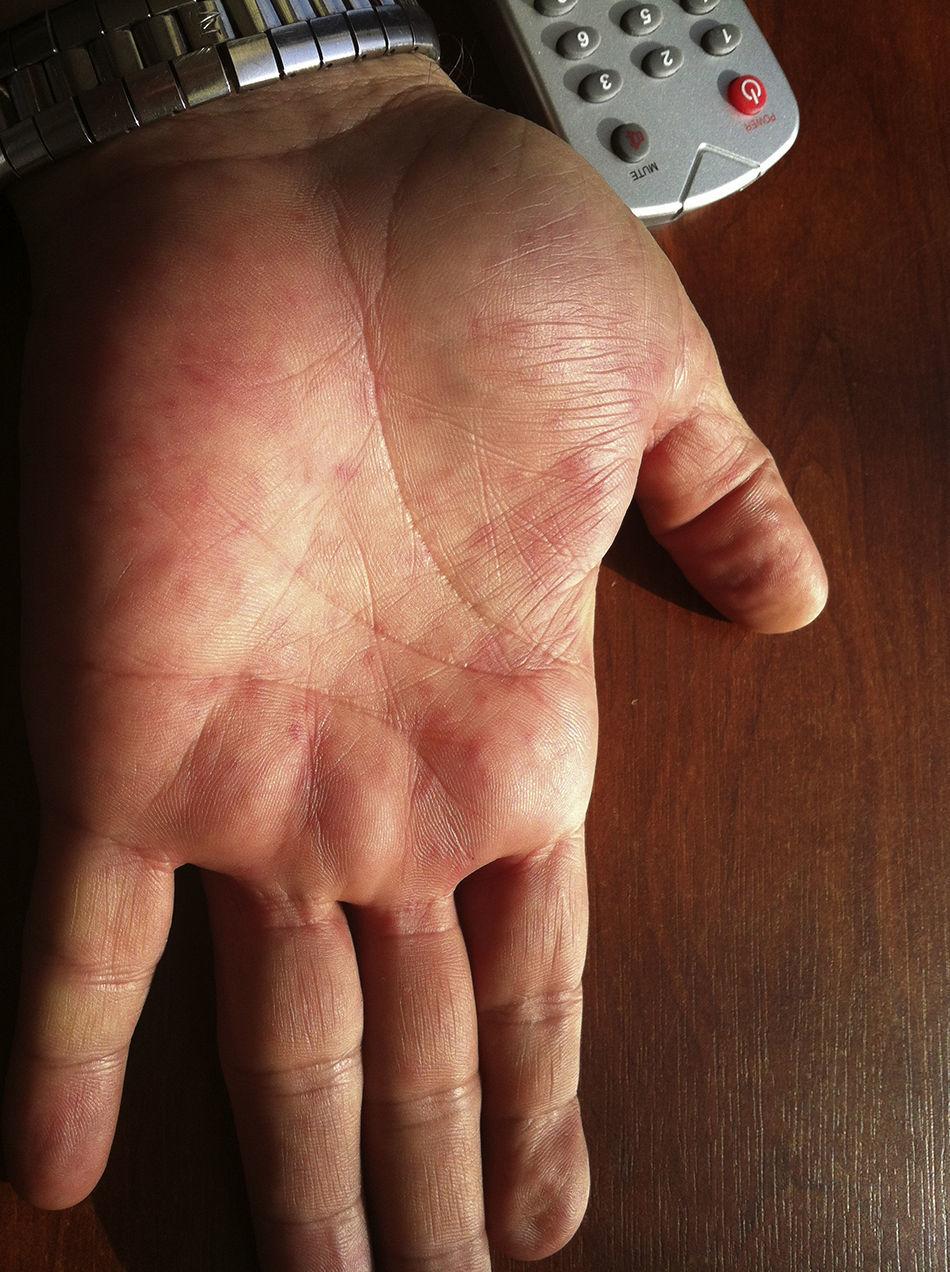 Hand, foot, and mouth disease in an adult | The Brazilian Journal of ...