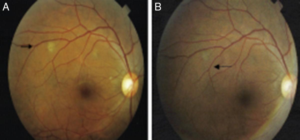 The impact of ocular tuberculosis on vision after two months of ...