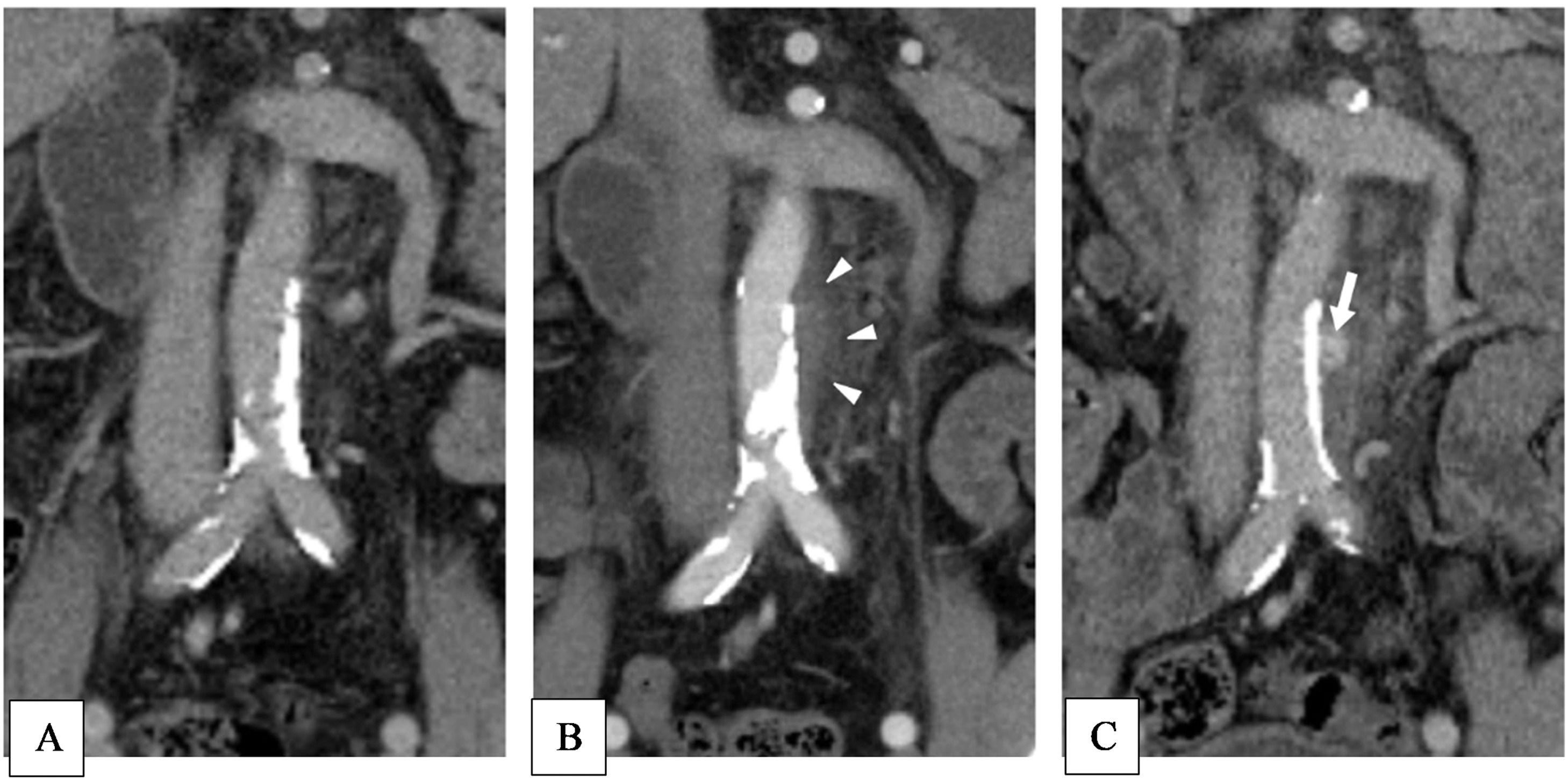 Infectious aortitis complicating ruptured mycotic aneurysm due to ...