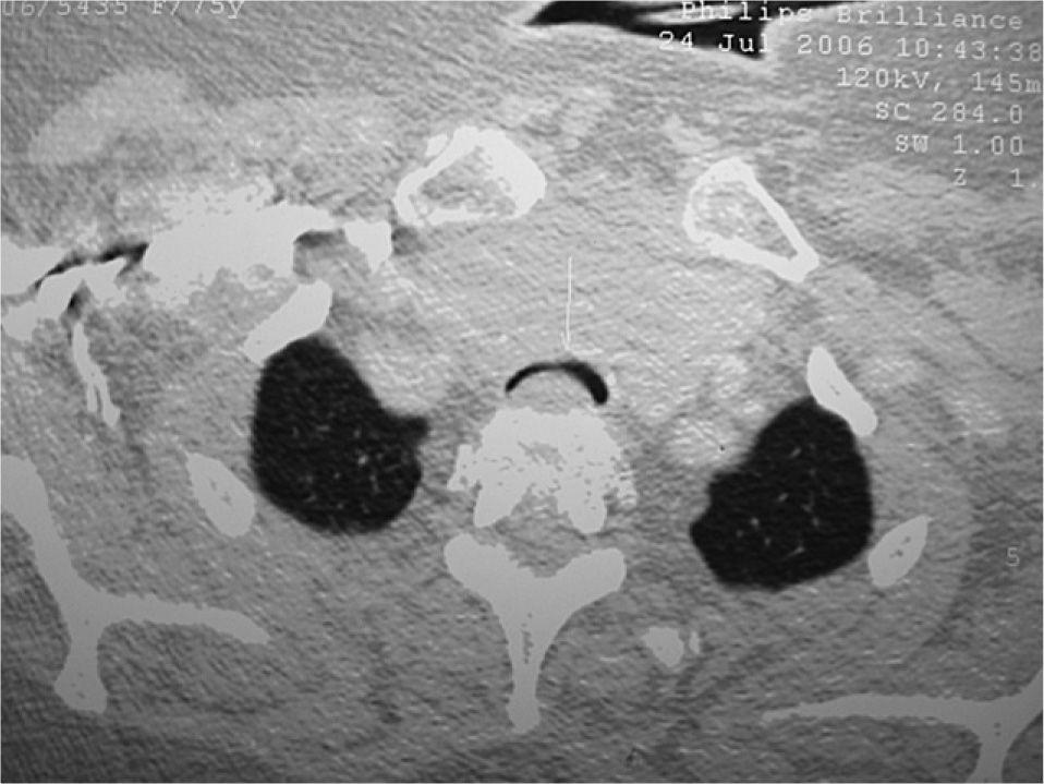 Disnea y estridor en paciente obesa por bocio multinodular ...