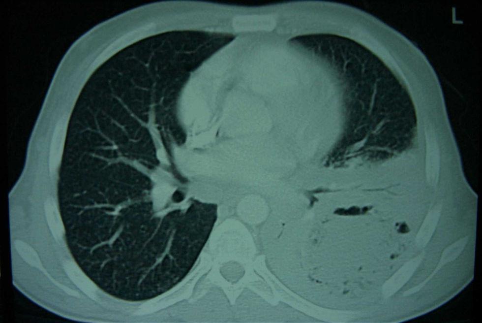 Absceso de pulmón como complicación de cirugía bariátrica ...
