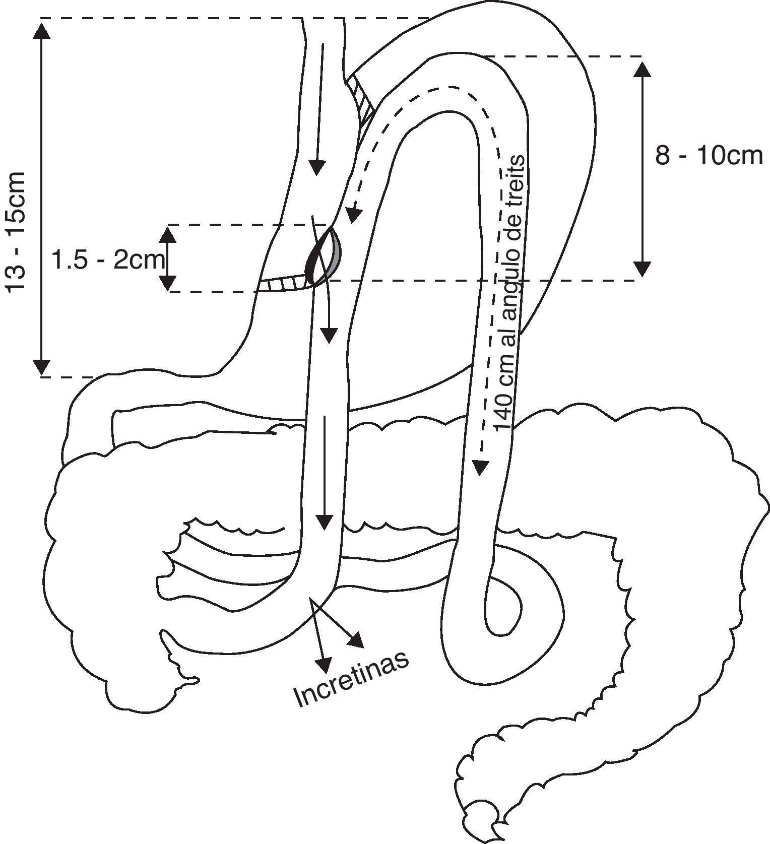 Cirugía metabólica: a propósito de 3 casos | Endocrinología y Nutrición