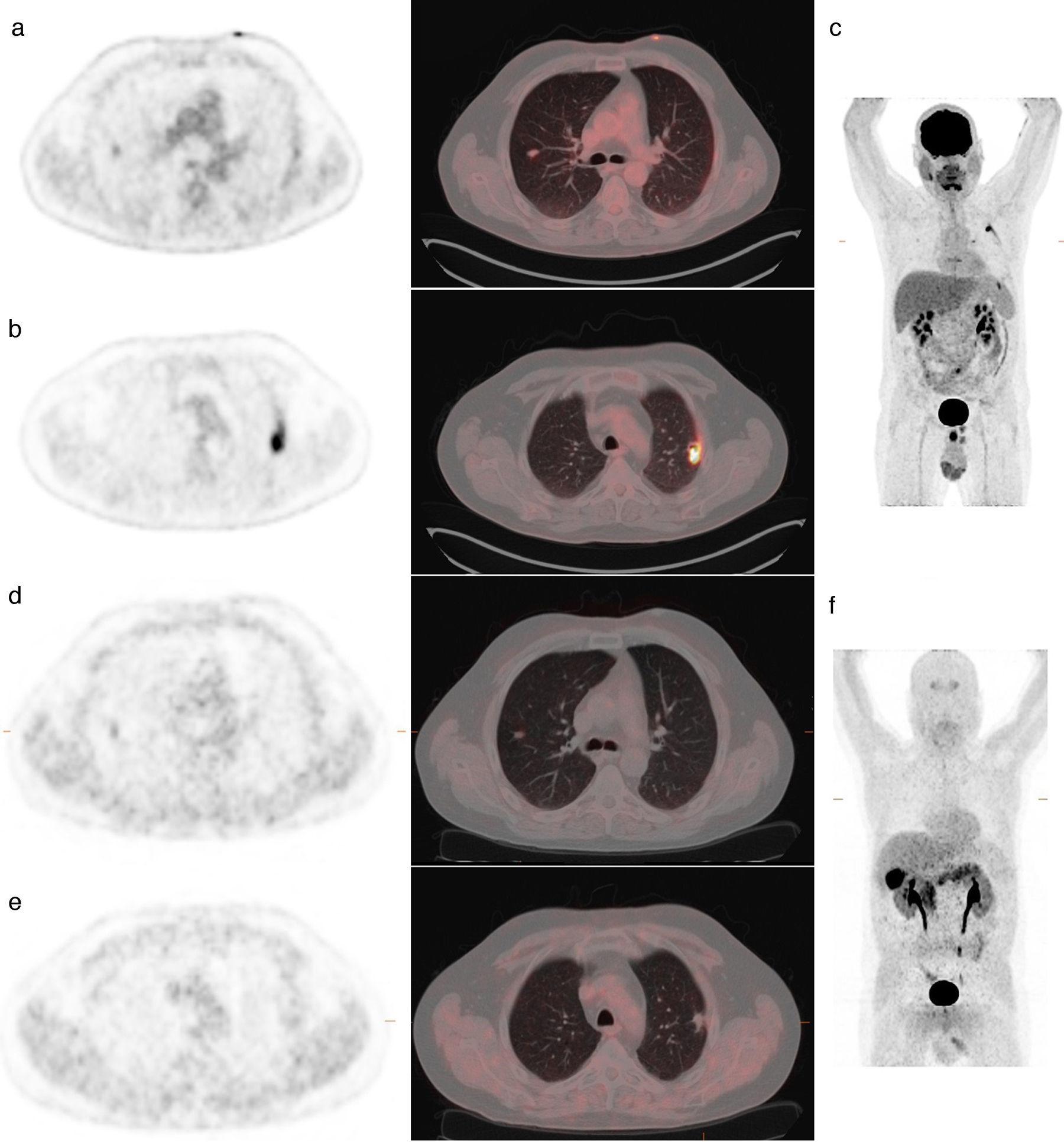 18F-DOPA vs. 18F-FDG PET/CT in the ectopic ACTH syndrome due to ...