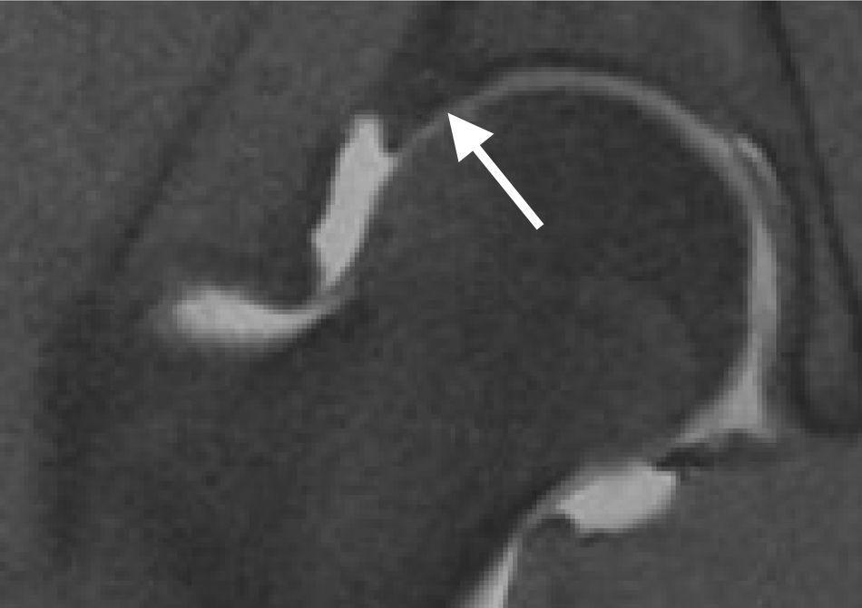 Atrapamiento femoroacetabular | Seminarios de la Fundación Española de ...