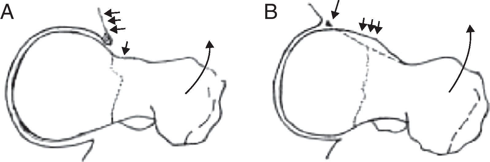 Atrapamiento femoroacetabular | Seminarios de la Fundación Española de ...