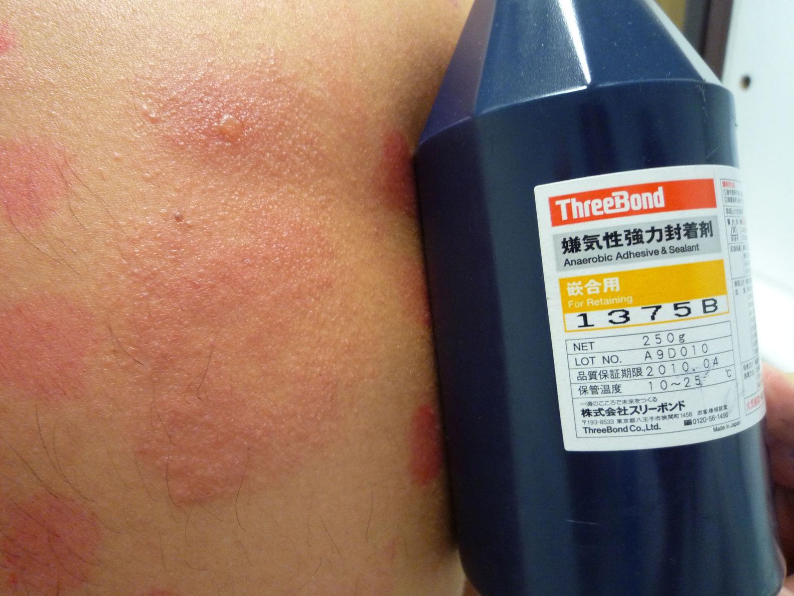 Occupational Contact Dermatitis Due to an Acrylic Resin (ThreeBond): 4 ...