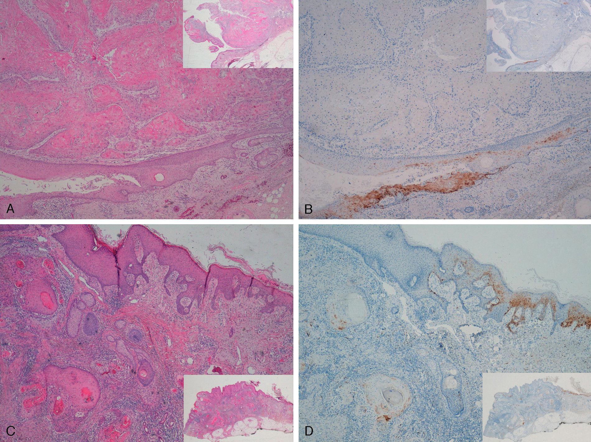 Immunohistochemical Staining of p16 in Squamous Cell Carcinomas of the ...