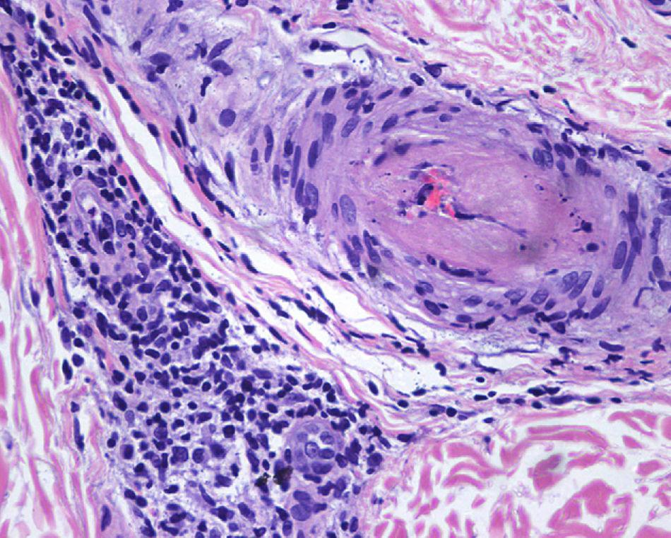 Blue Toe Sign as the Initial Manifestation of a Popliteal Artery ...