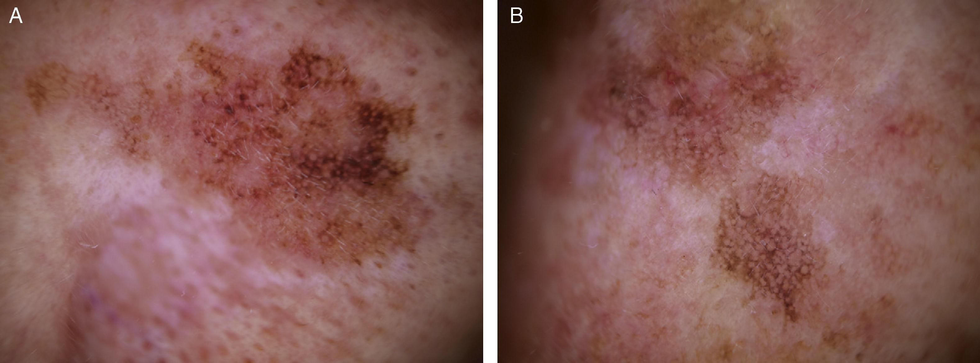 Actinic Keratosis Nose
