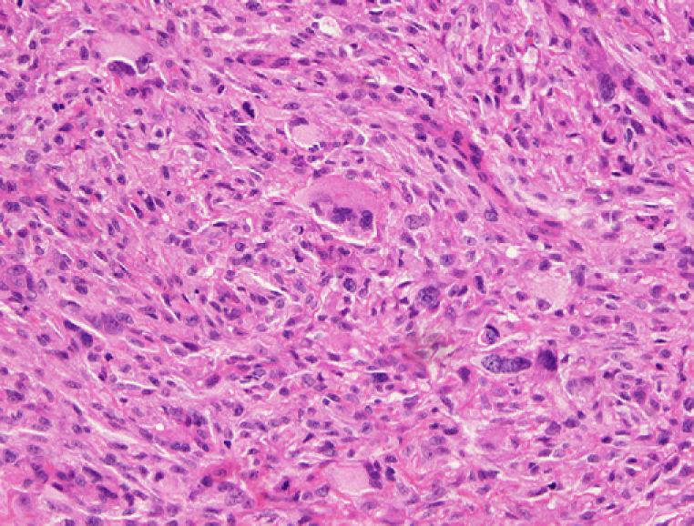 Crateriform Nodule on the Helix of the Ear | Actas Dermo-Sifiliográficas