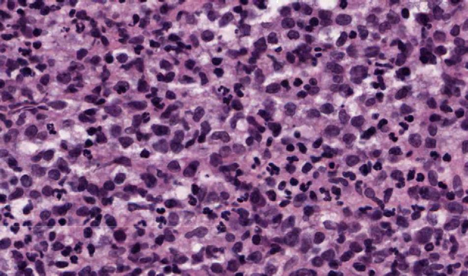 Myeloid Sarcoma in the Area of a Skin Flap | Actas Dermo-Sifiliográficas