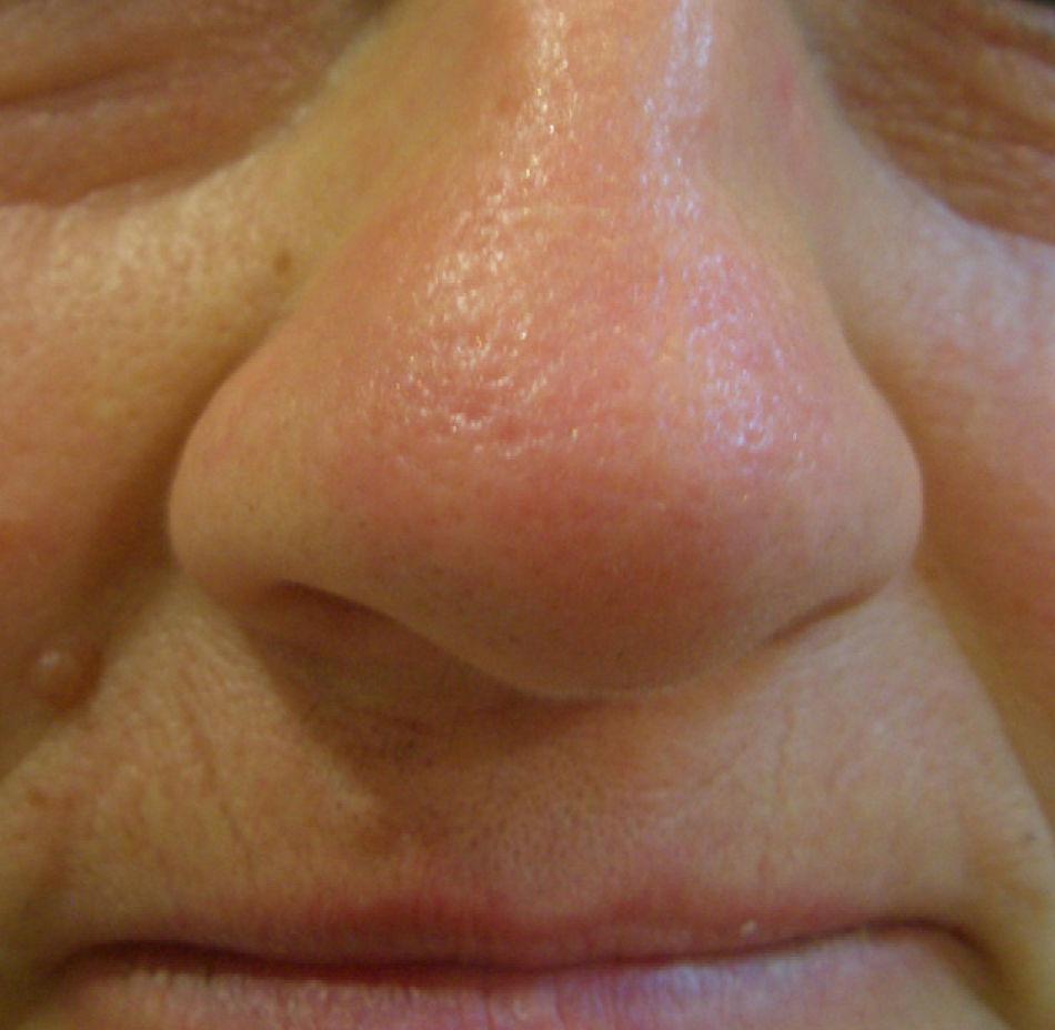 Lupus Pernio Nose