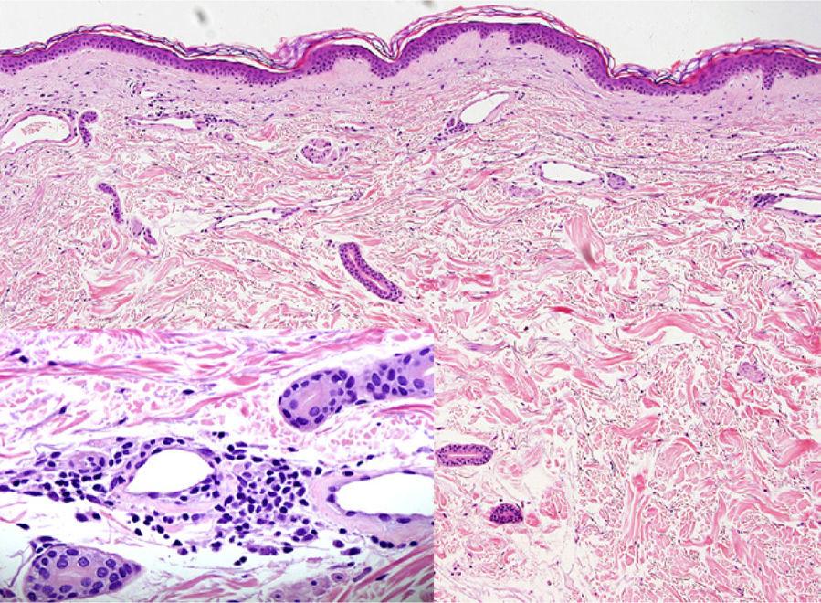 Urticaria Pigmentosa Histology