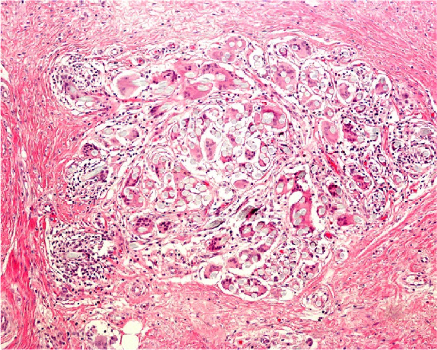 Basic Concepts in Skin Biopsy. Part II | Actas Dermo-Sifiliográficas
