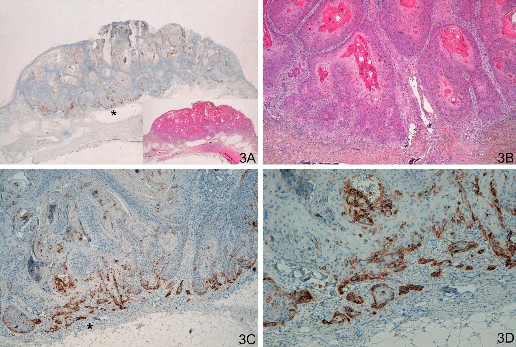 The Value of Laminin-322 Staining in Distinguishing Between ...