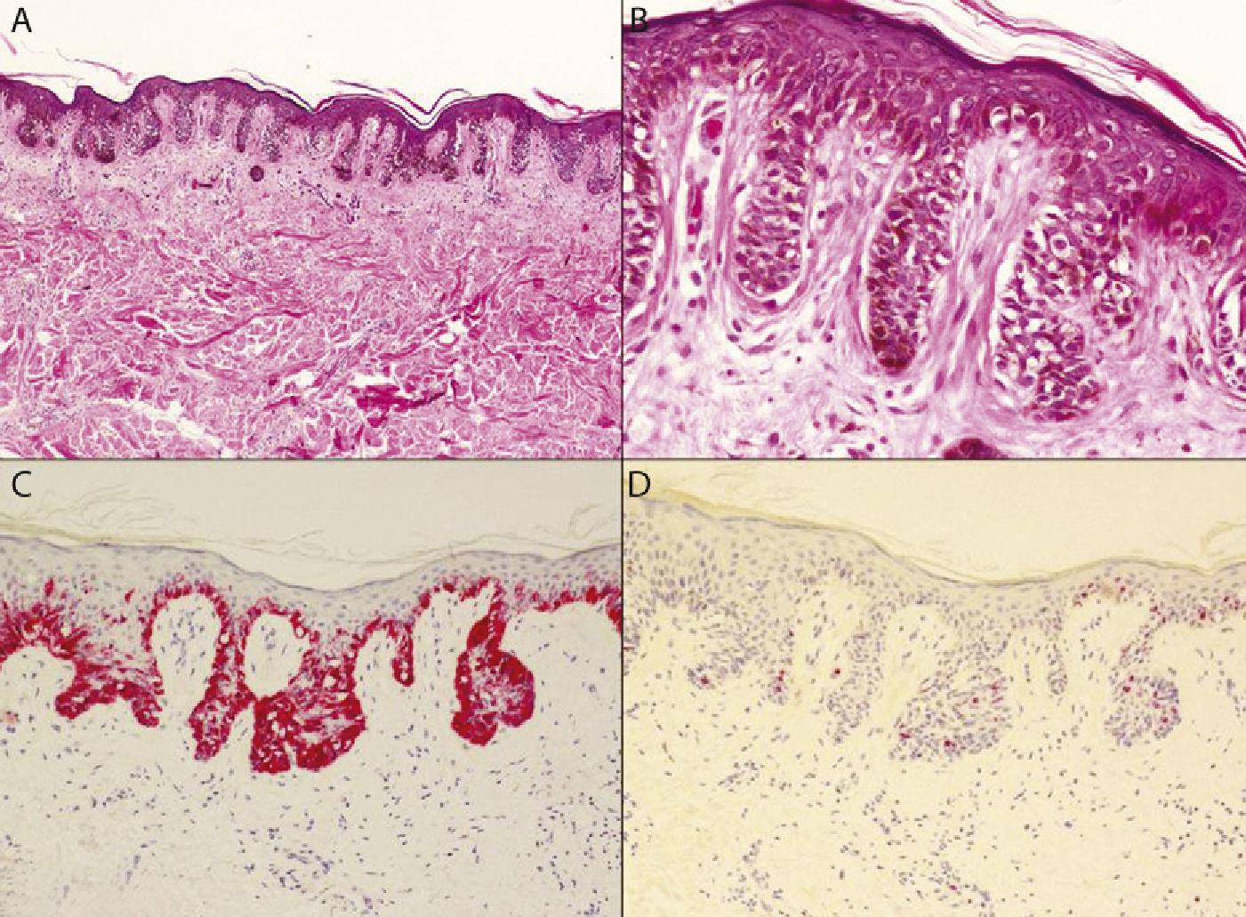 Atypical Lentiginous Nevus: A Clinical and Histopathologic Study of 14 ...