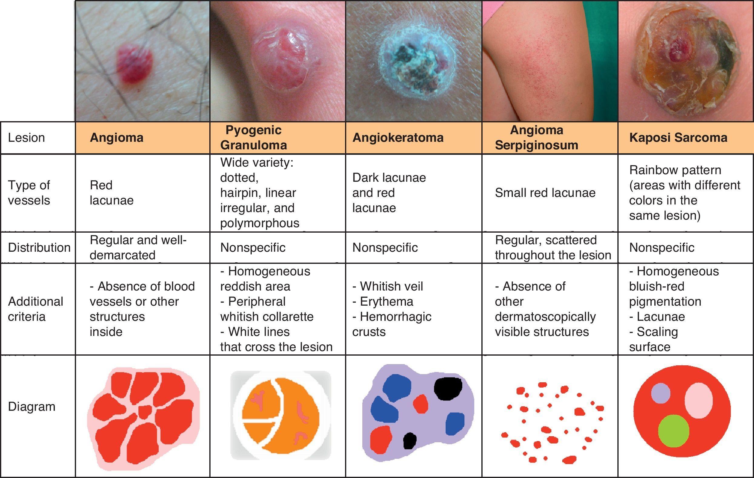 Vascular Patterns in Dermoscopy | Actas Dermo-Sifiliográficas
