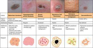 Vascular Patterns in Dermoscopy | Actas Dermo-Sifiliográficas
