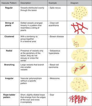 Vascular Patterns in Dermoscopy | Actas Dermo-Sifiliográficas