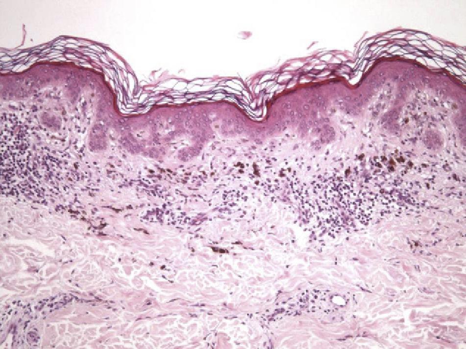 Melanocytic Nevus Histology