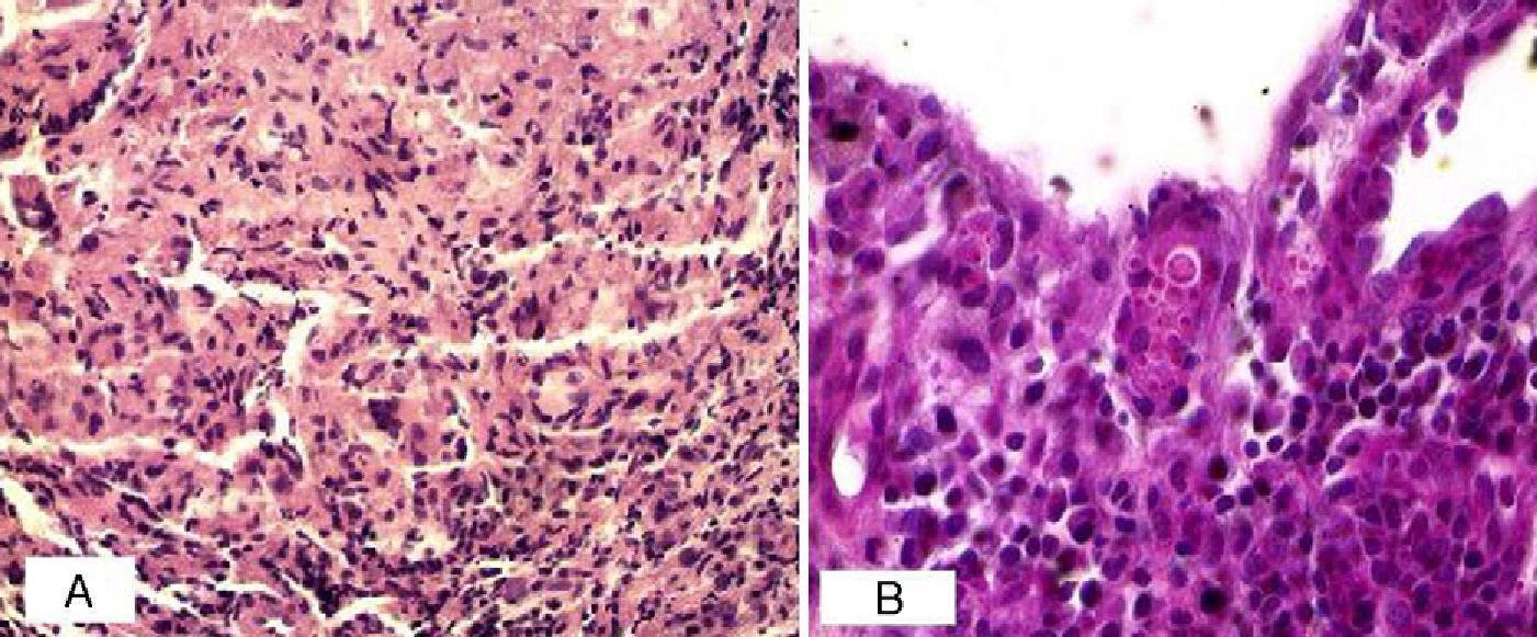 Paracoccidioidomycosis Histology