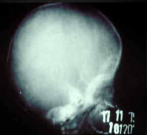 Congenital Syphilis in the 21st Century | Actas Dermo-Sifiliográficas