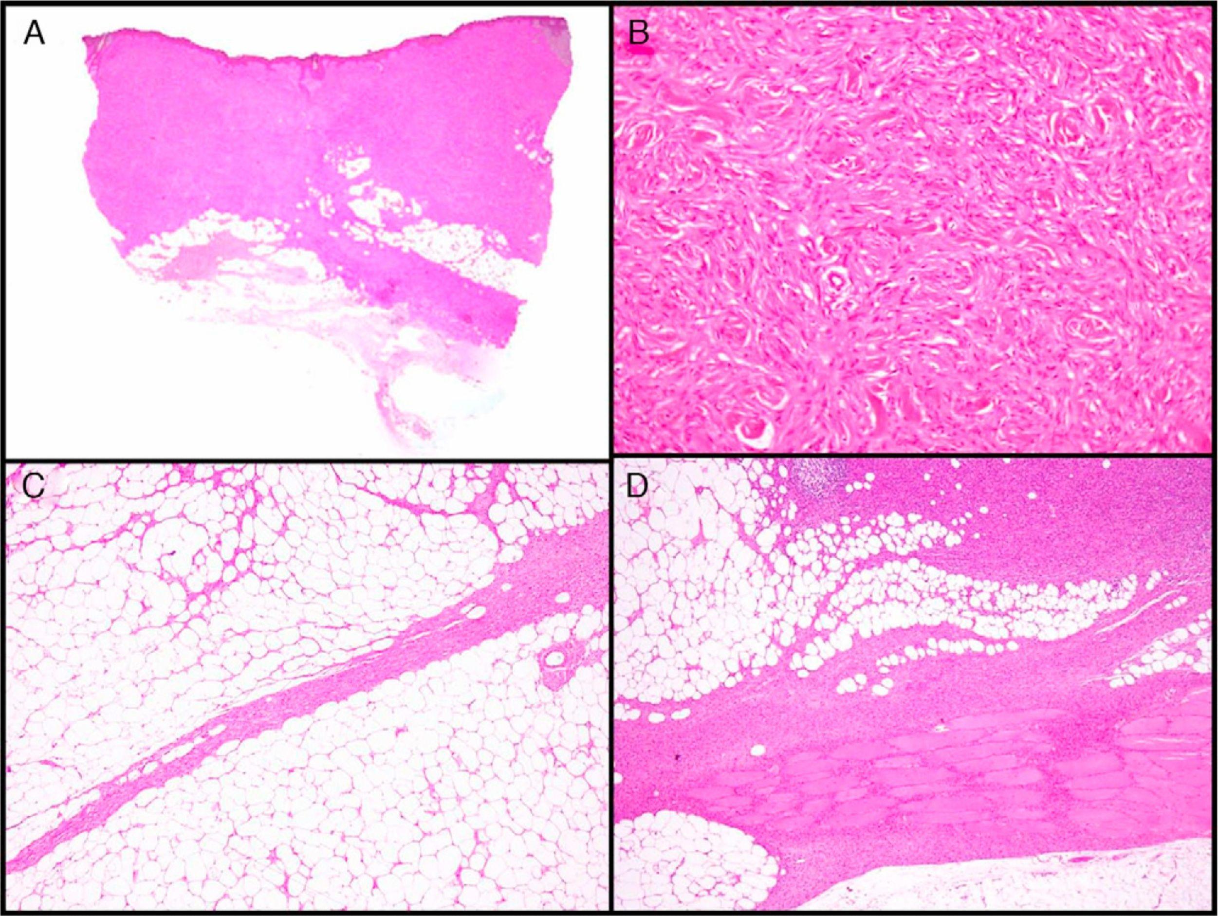 Dermatofibrosarcoma Protuberans | Actas Dermo-Sifiliográficas