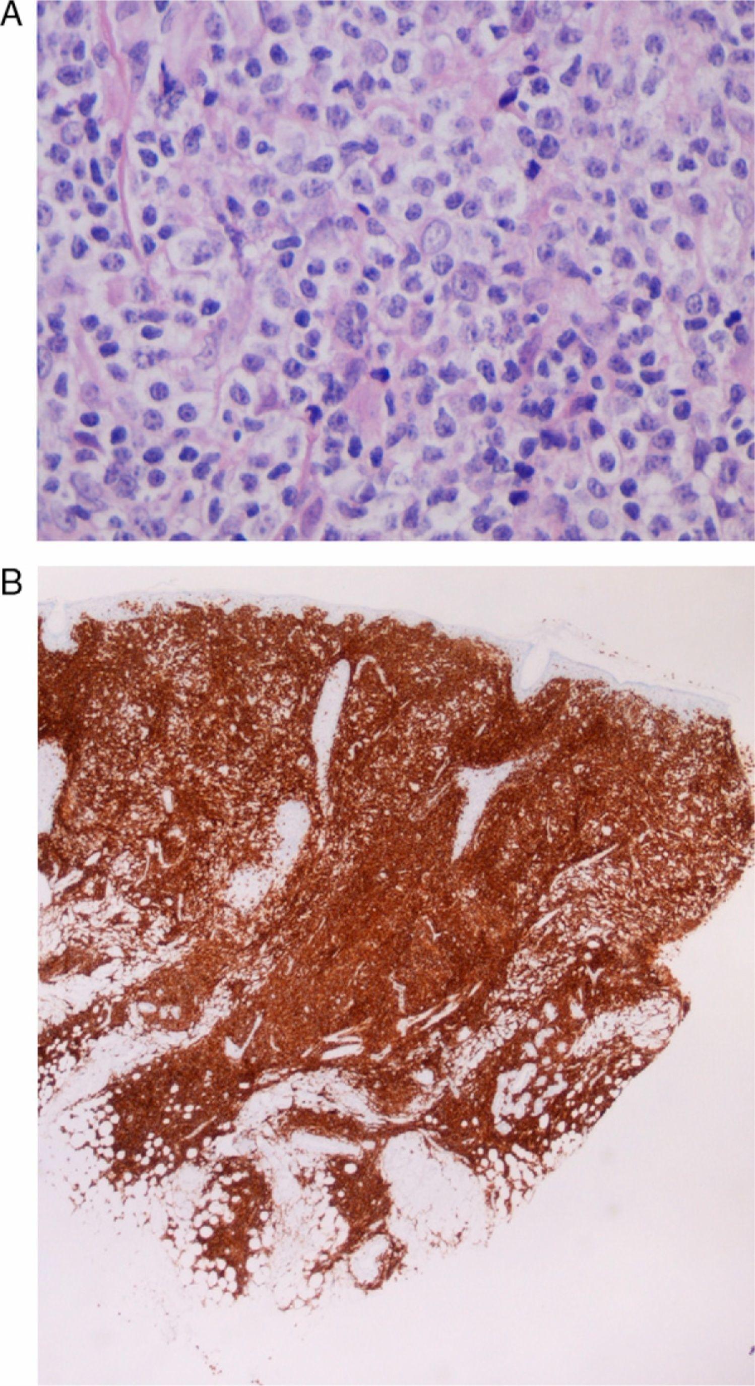 Wolf's Isotopic Response: A Series of 9 Cases | Actas Dermo-Sifiliográficas